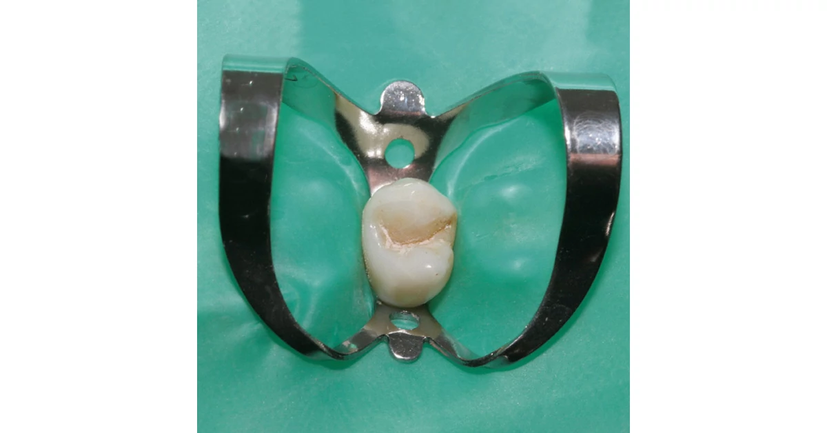 box dam technique — Dental products